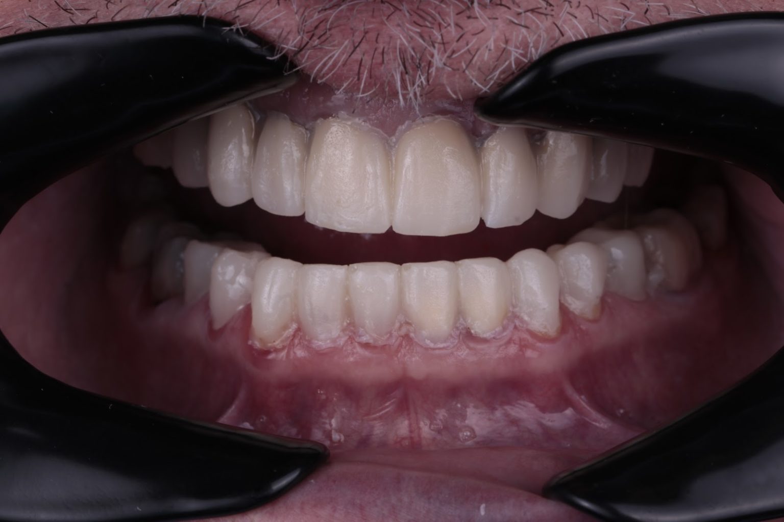 Diagnostic Dental Mock Up Services | Chicago Dental Solutions