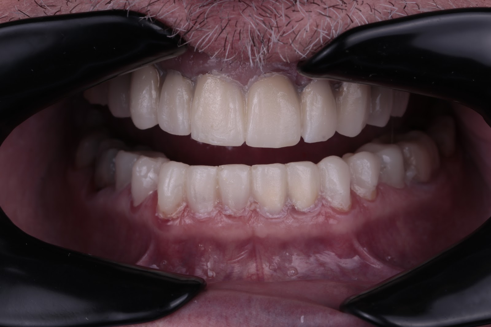 Diagnostic Mock-Ups (Try-On Smile) - Chicago Dental Solutions