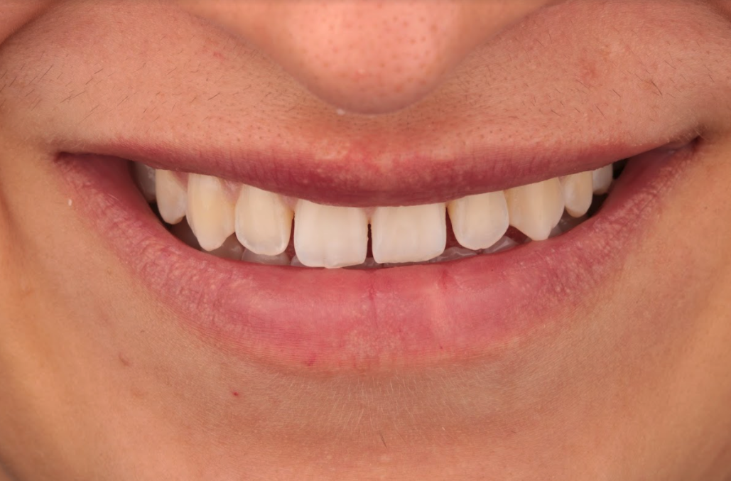 Diagnostic Dental Mock Up Services | Chicago Dental Solutions